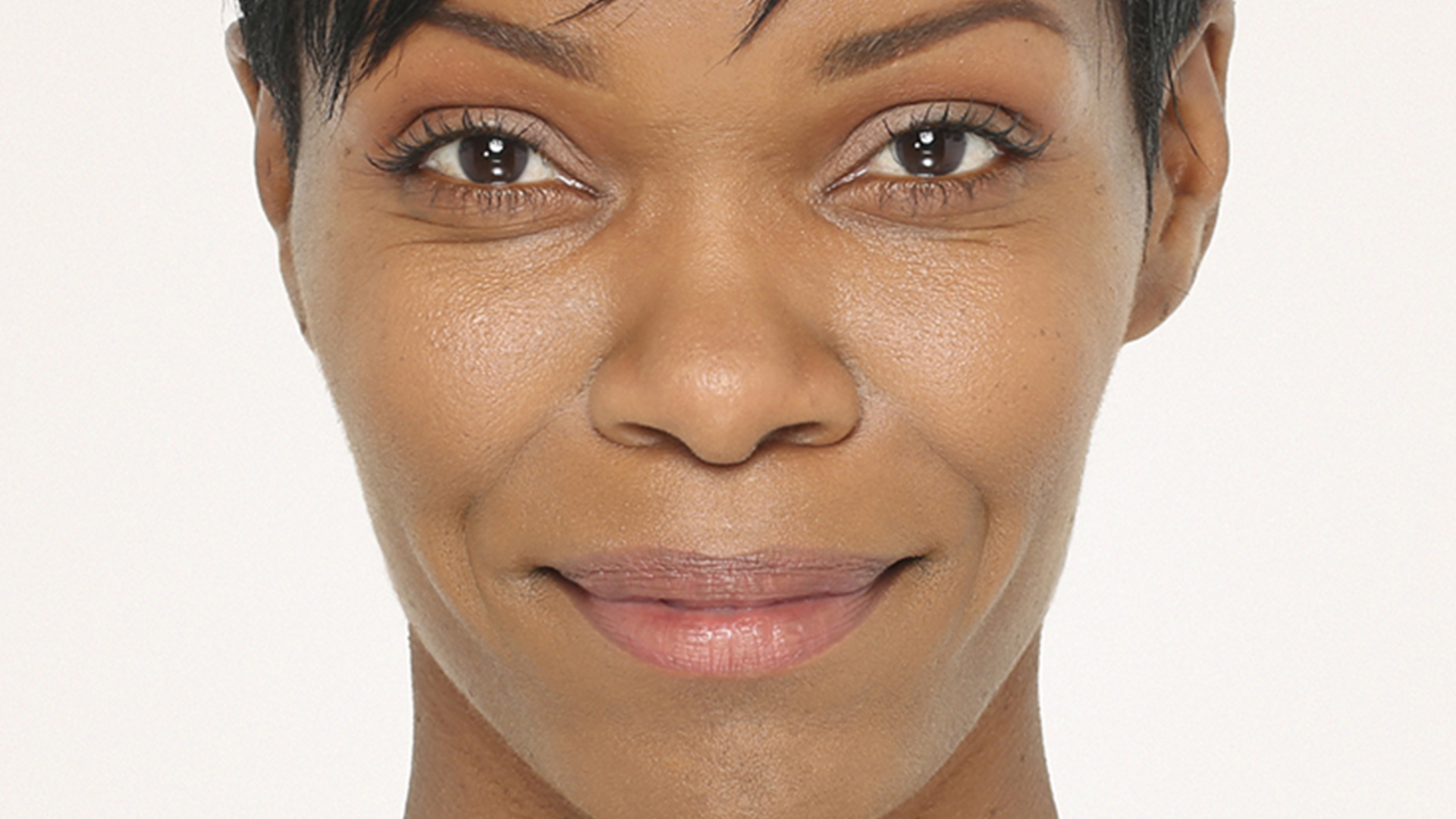 What Is Radiesse? - San Diego Neu Look Med Spa & Skin Center