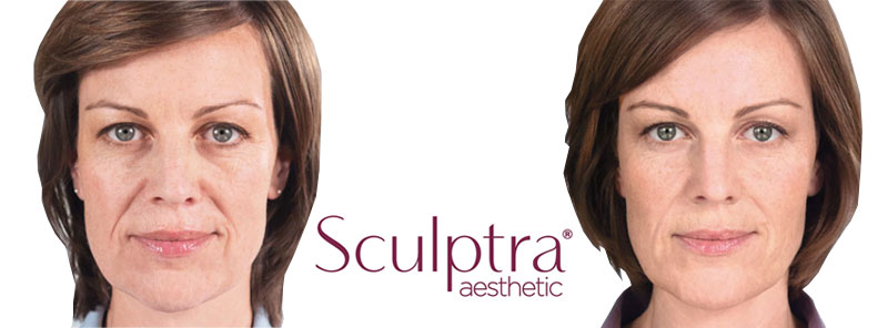 Sculptra | Cheek Filler I Reduce Face Lines | San Diego I Neu Look Med